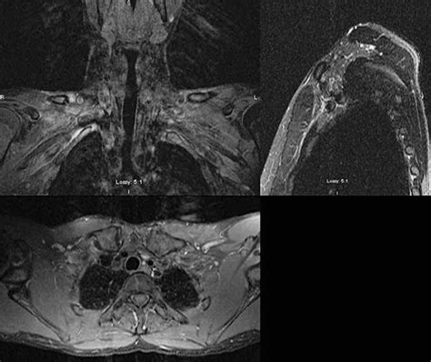 Mri Of The Left Brachial Plexus Using The Conventional Technique In Download Scientific