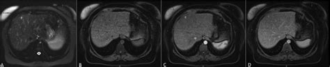 Initial Mri Performed For Hcc Screening Showing Lesion In Segment 4a Download Scientific
