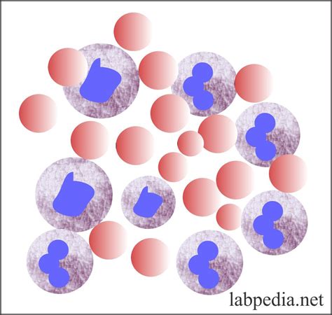 Leukemoid Reaction And Diagnosis D D From Chronic Myelocytic Leukemia
