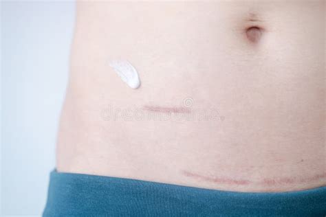 Using Cream To Care For Scars After Appendix Surgery And Postpartum
