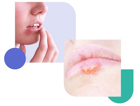 Consult A Dermatologist For Herpes