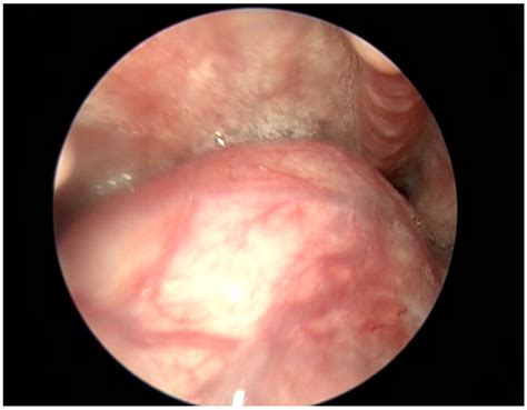 Tongue Base Ectopic Thyroid Tissue—is It A Rare Encounter