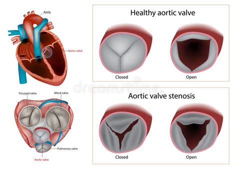 Congenital Aortic Stenosis