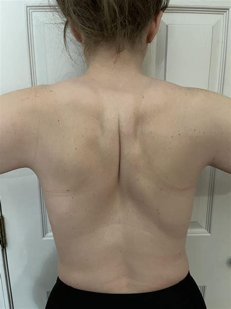 Do I Have Scapular Winging R Medical Advice