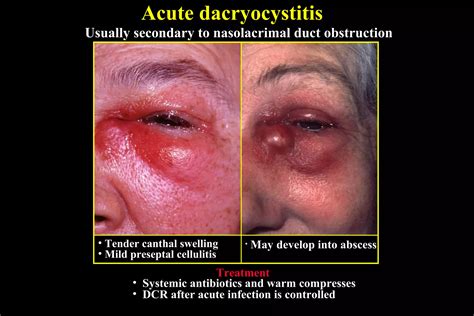08 Infection Lacrimal Ppt