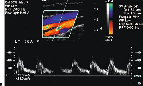 Extracranial Carotid And Vertebral Arteries Thoracic Key