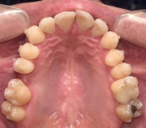 Case Gallery Clearcorrect