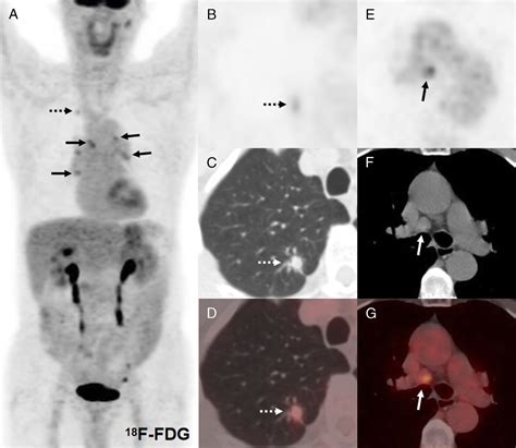 Differentiation Of Reactive Lymph Nodes And Tumor Metastatic Clinical Nuclear Medicine