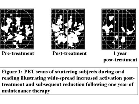 Neural Bases Of Stuttering And Its Treatment Stuttering Foundation A Nonprofit Organization
