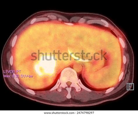 Pet Ct Scan Reveals Cholangiocarcinoma Suspected Stock Illustration