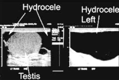 A Ultrasonography Showing Left Sided Hydrocele Download Scientific Diagram
