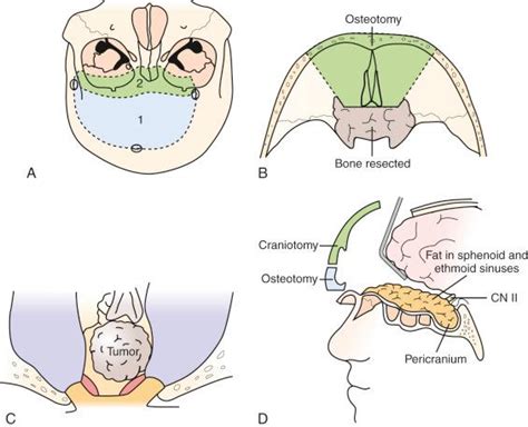 Skull Base Tumors Evaluation And Microsurgery Clinical Tree