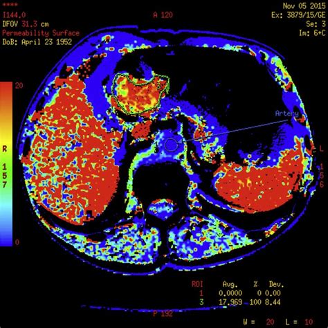 Perfusion Ct Exam Permeability Surface Ps Vascular Endothelial