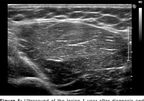 Figure 4 From Myositis Ossificans Circumscripta Of The Triceps Due To Overuse In A Female
