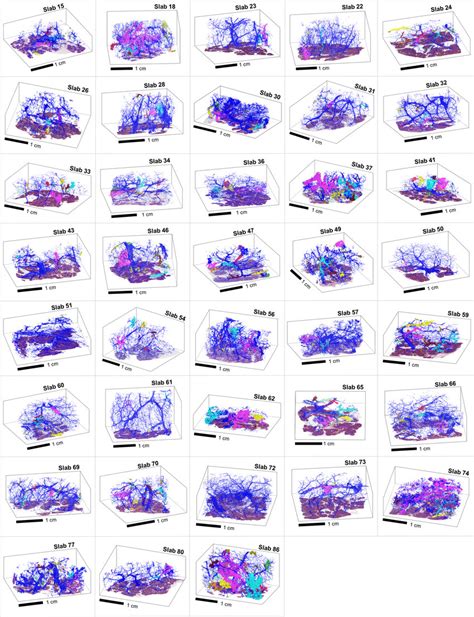 Nature：科学家开发出有望揭示人类胰腺癌癌前病变的新型3d技术生物科技健康一线资讯