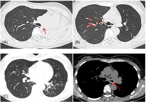 12mm Nodule Lung