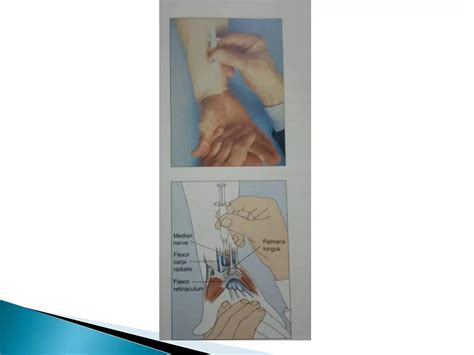 Joint And Soft Tissue Injections Pptx