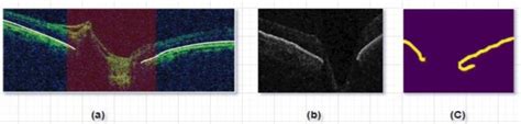 A Oct Image B Processed Image C Rpe Layer Download Scientific Diagram