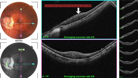 Late Erm 6 Months With Cme Abbreviations Cme Cystoid Macular Edema Download Scientific