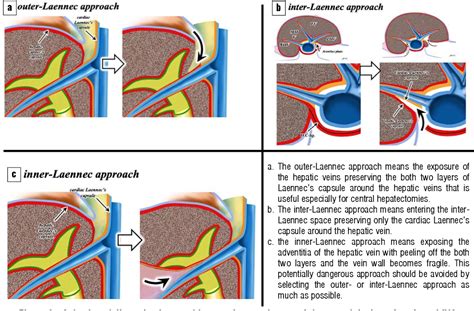 Figure 8 From Standardization Of Anatomic Liver Resection Based On Laennecs Capsule Semantic