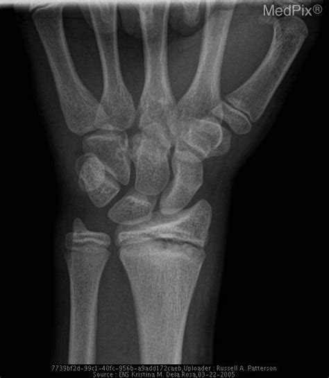 Salter Fracture Type 2