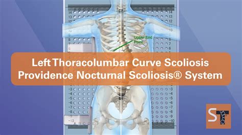 Spinal Technology On Linkedin Left Thoracolumbar Curve Providence Nocturnal Scoliosis® System