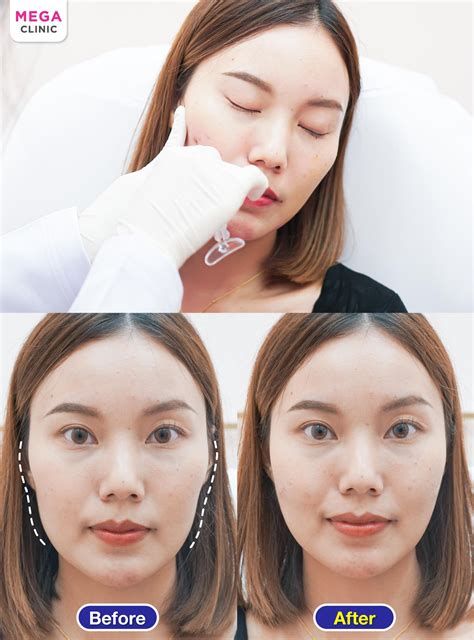 ฟิลเลอร์แก้มตอบ แก้หน้าโทรม เติมเต็มความสดใส Mega Clinic