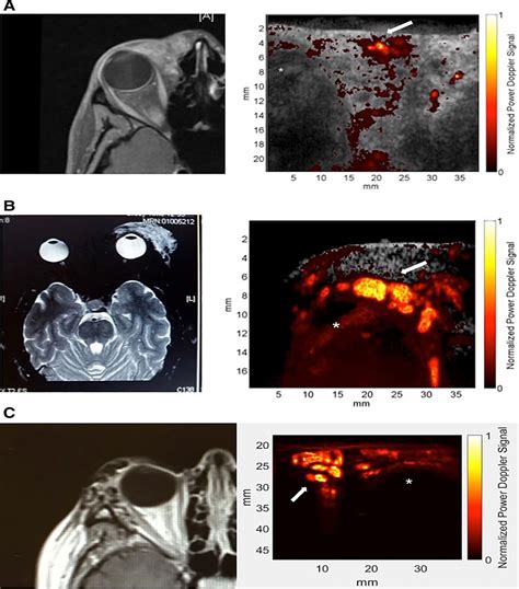 Compound Coherent Plane Wave Ultrasound Imaging Of Vascular Ophthalmic Plastic