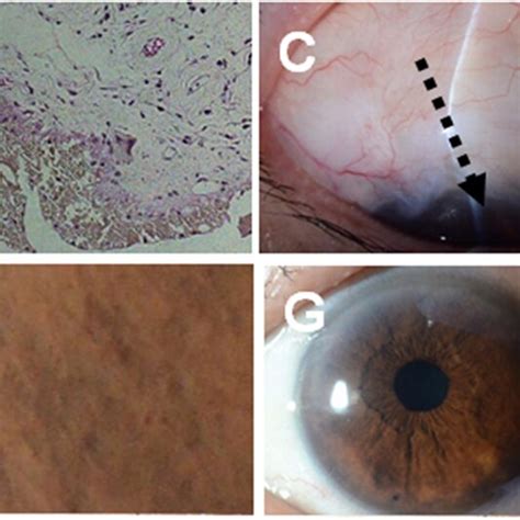 Histology Of The Intraoperatively Resected Iris Is Shown In A And B A