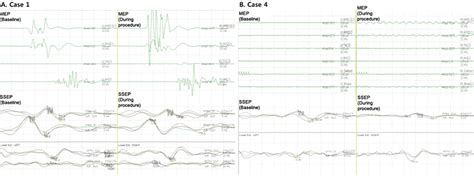 Join Journal Of Intraoperative Neurophysiology