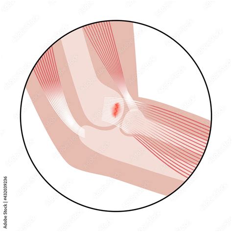 Lateral Epicondylitis Tennis Elbow Stock Vector Adobe Stock