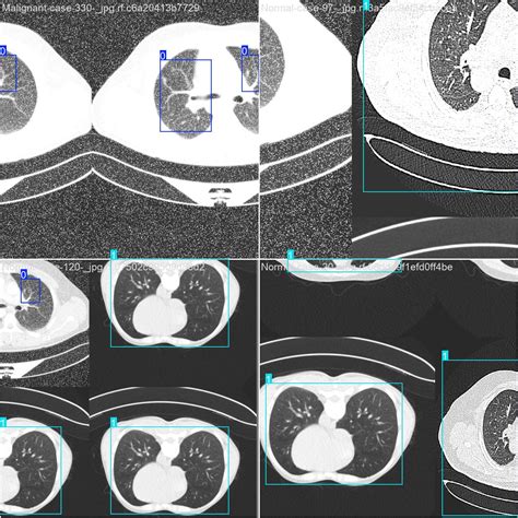 基于yolov8深度学习的医学影像肺癌自动诊断及语音提示系统基于深度学习的肺功能下降程度预测模型的设计与实现 Csdn博客