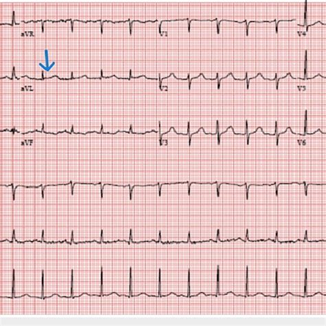 Ekg Showing Complete Resolution Of St Segment Elevation In Lateral Leads Download Scientific