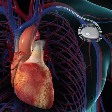 What Is A Pacemaker And How Does It Work