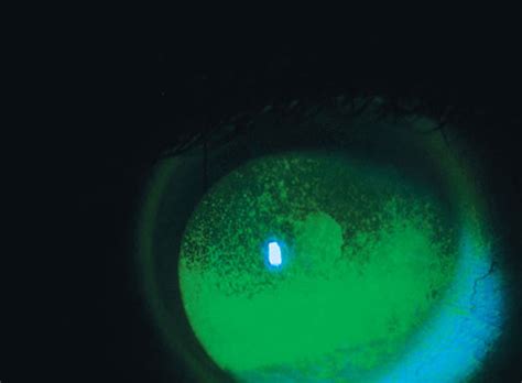 Punctate Epithelial Erosions