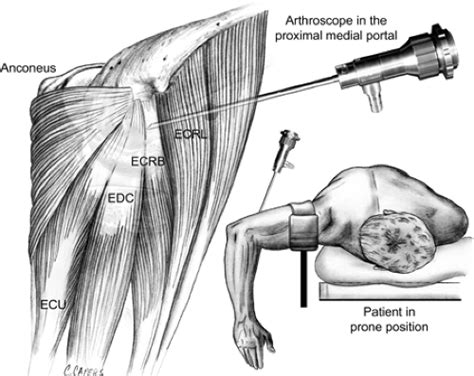 Arthroscopic Treatment Of Lateral Epicondylitis Of The Elbow