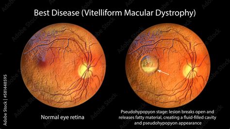 Best Disease 3d Illustration Showing Normal Eye Retina And Best Vitelliform Macular Dystrophy