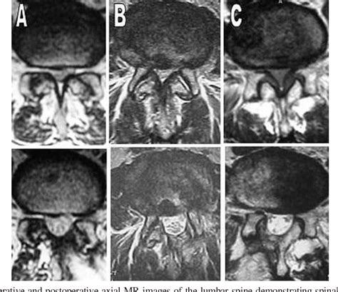 Figure 1 From Idiopathic Spinal Cord Herniation Semantic Scholar