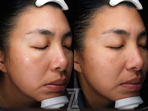 Moxi Before And After Photos The Piazza Center