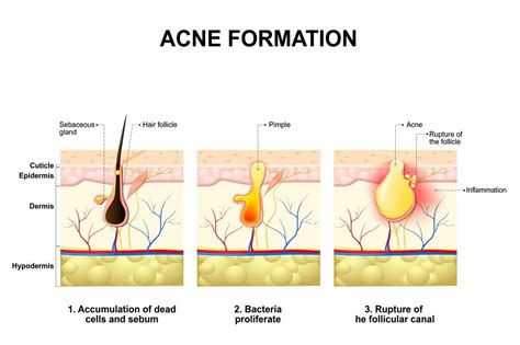 What Is Acne Definition Symptoms Causes Types Risk Factors