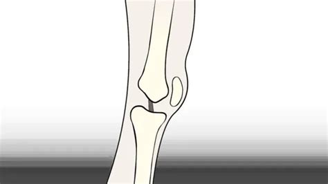 Regenexx Procedures For Knee Injuries And Arthritis Advanced Pain