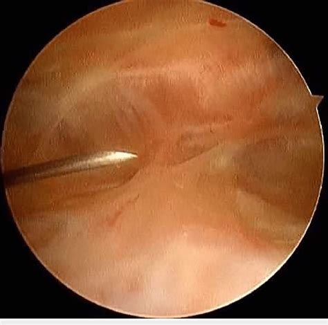 Arthroscopic View Of The Suprapatellar Region Of The Right Knee