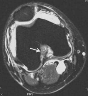 Anterior Cruciate Ligament Acl Mri Practice Essentials Anatomy