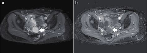 A Diffusion Weighted Image Showing A Heterogeneous High Intensity