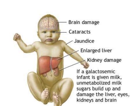 Metabolic Disorders Flashcards Quizlet