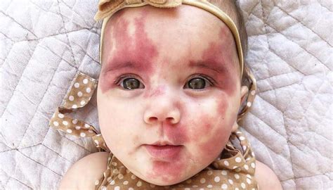 What Is The Difference Between A Port Wine Stain And A Haemangioma