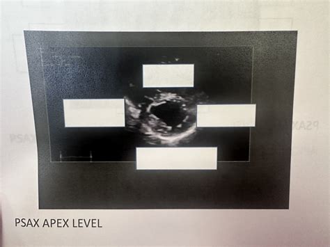 Labeling Wall Segments PSAX APEX LEVEL Diagram Quizlet