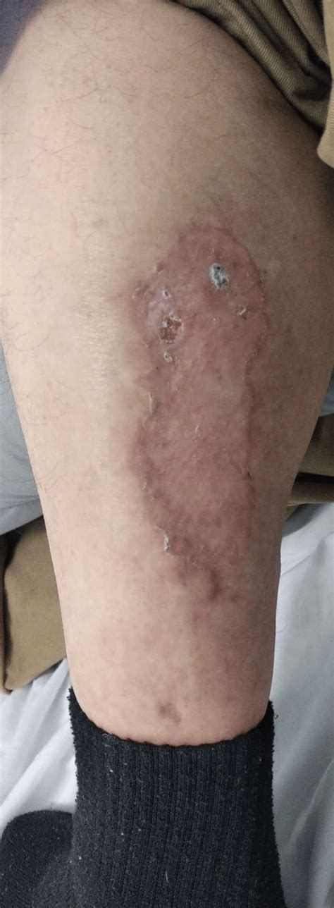 Calciphylaxis Beating The Odds Pmc