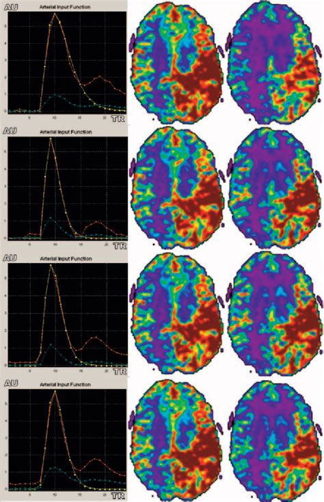 Figure 1 From Perfusion Measurement Of Arterial Input Function Extractions For Brain