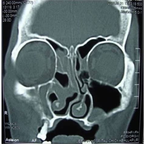 Ct Scan Showing Polypoidal Mucosal Thickening Of Right Maxillary And Download Scientific